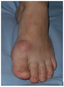 Painful Big Toe Joint (Hallux Limitus/Rigidus) | Belfast Health ...