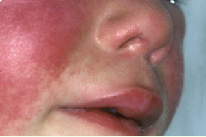 Scarlet fever and Group A Strep | Belfast Health & Social Care Trust ...