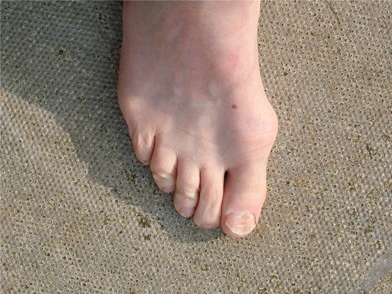 Hallus Valgus (Bunions) Patient Information | Belfast Health & Social ...