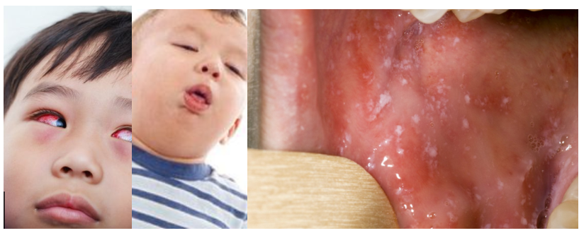 Measles | Belfast Health & Social Care Trust website