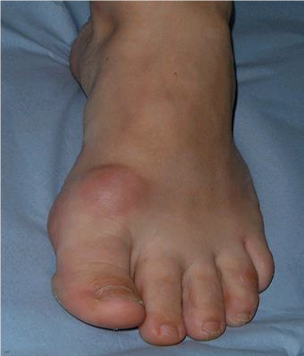 Painful Big Toe Joint (Hallux Limitus/Rigidus) Patient Information ...