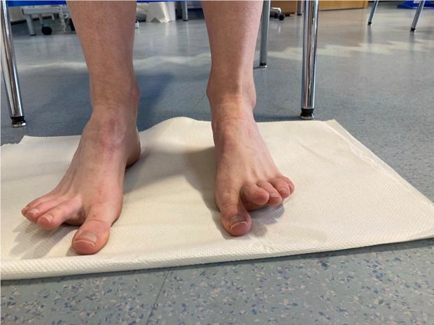 Painful Big Toe Joint (Hallux Limitus/Rigidus) Patient Information ...